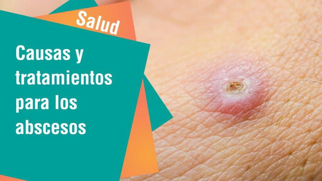 Cuanto tarda en madurar un absceso